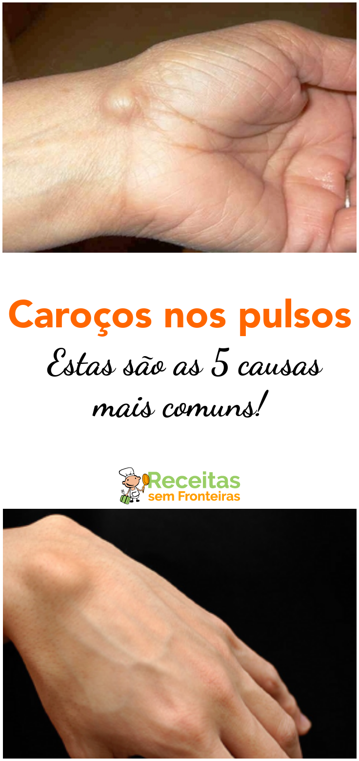 Você tem caroços nos pulsos? Estas são as 5 causas mais comuns!